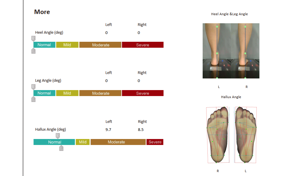 ScanPod3D 3D Laser Foot Scanner | Orthotic Insole CAD & CAM ...