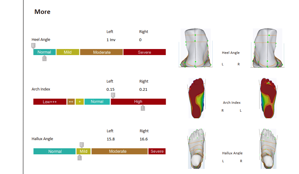ScanPod3D 3D Laser Foot Scanner | Orthotic Insole CAD & CAM ...