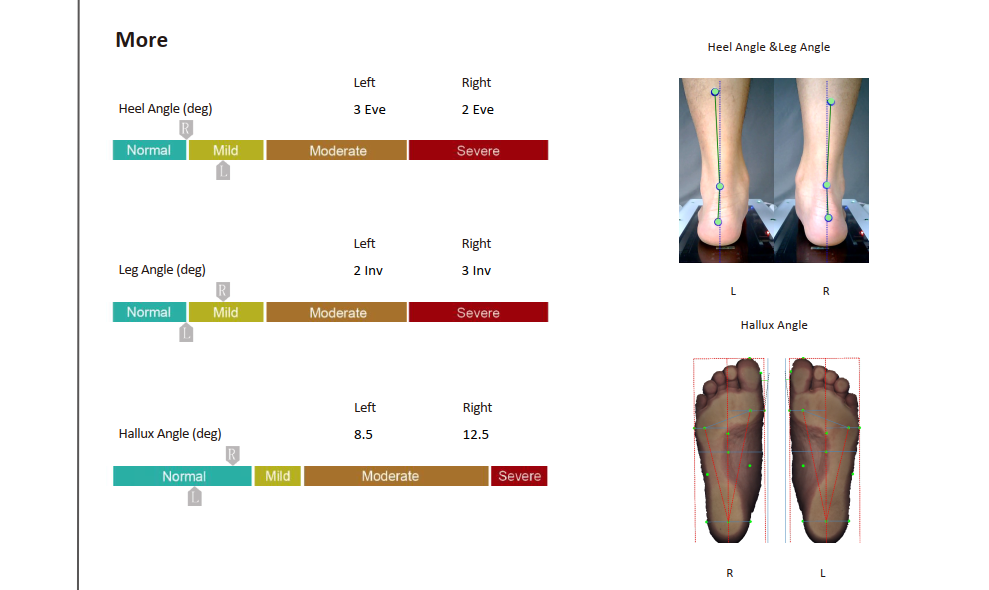 ScanPod3D 3D Laser Foot Scanner | Orthotic Insole CAD & CAM ...